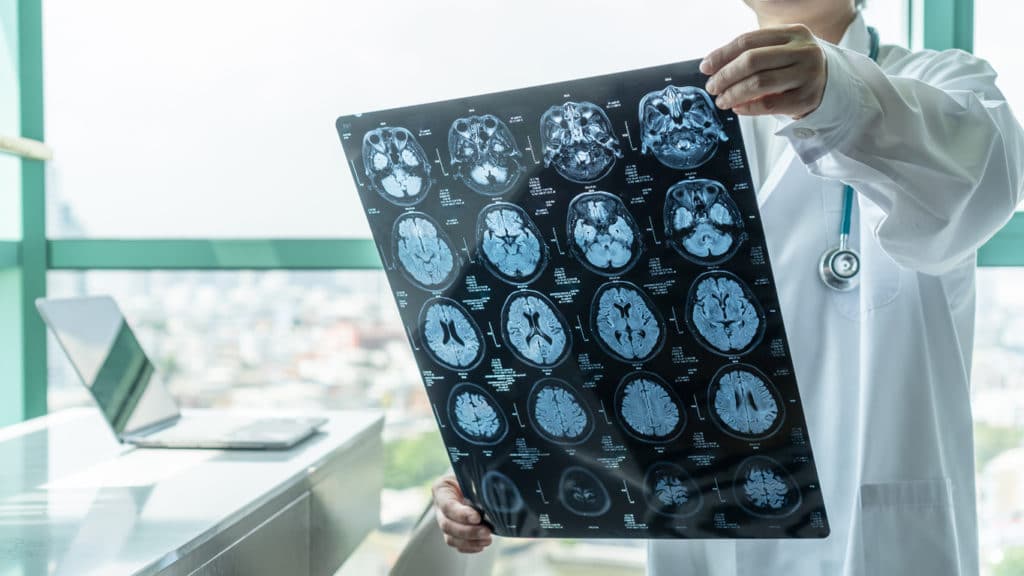 What You Need to Know About Brain Stem Injuries